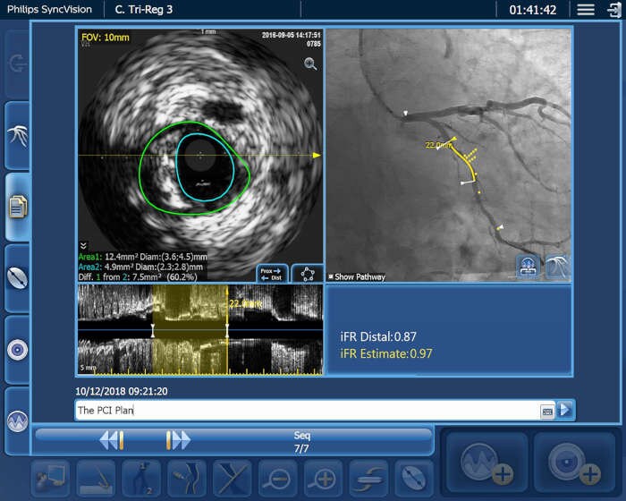 IntraSight Interventional Applications Platform | Philips